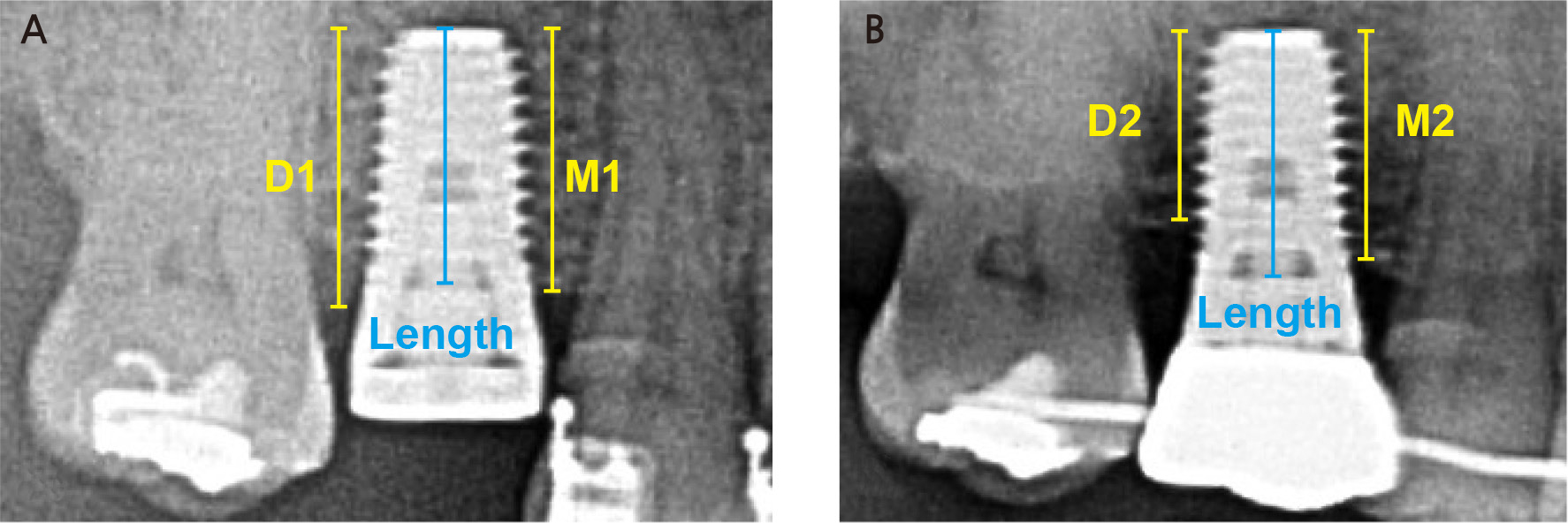 A Retrospective Study on the Factors Affecting the Early Marginal Bone ...