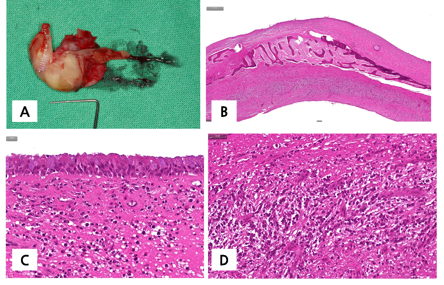 One-step Approach for Radicular Cyst Removal in the Maxillary Sinus and ...