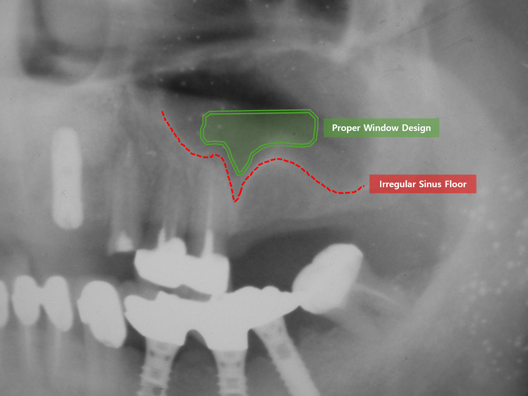 Lateral Approach for Maxillary Sinus Augmentation: A Step-by-Step ...